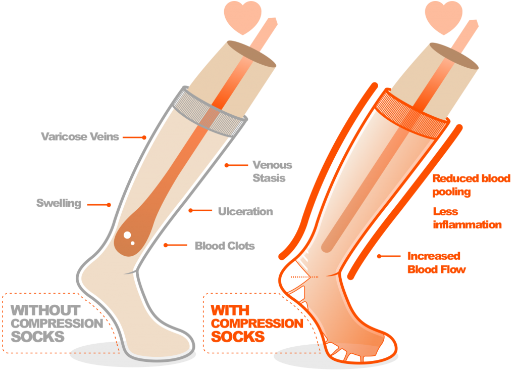 The Benefits Of Compression Socks For A Sprained Ankle Vitalsox The Benefits Of Compression Socks For A Sprained Ankle Vitalsox